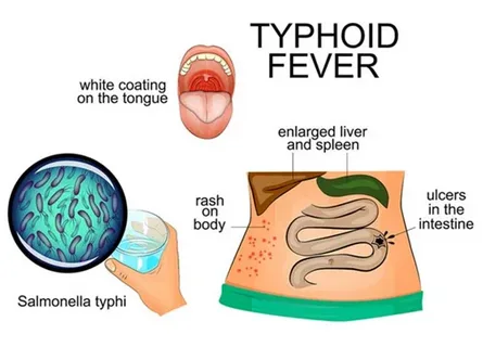 How To Prevent Typhoid Fever In Nigeria - Labclinic56